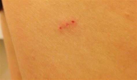 Bite Marks Prevention Of Bite Marks Kiwicare