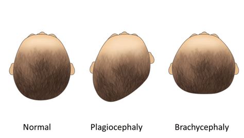 Plagiocephaly