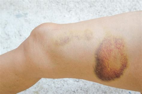 15 Ways For Natural Home Cures For Hematoma