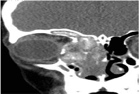 Coronal Ct Paranasal Sinuses Shows Heterogeneous Opacities Filling The