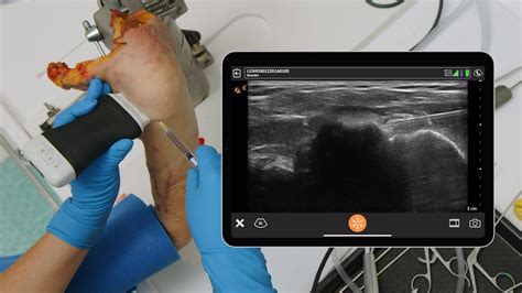 Biceps Tendon Injection Techniques Youtube