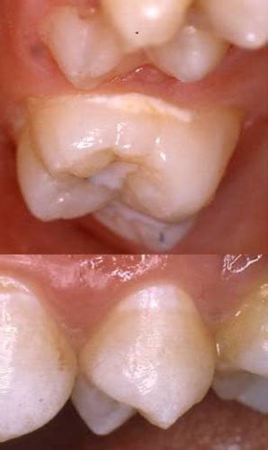 Enamel Caries Flashcards Quizlet