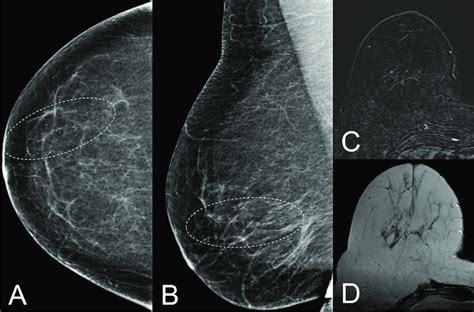 Screening Detected Segmental Linear And Coarse Heterogeneous