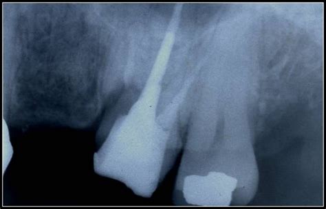 Root Amputation A Prudent Alternative To Tooth Extraction
