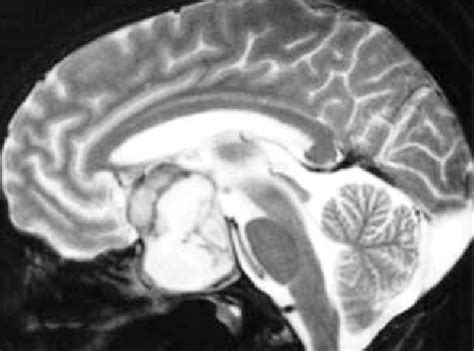 T2w Sagittal Mr Image Showing A Sellar Mass With Thickened Stalk And