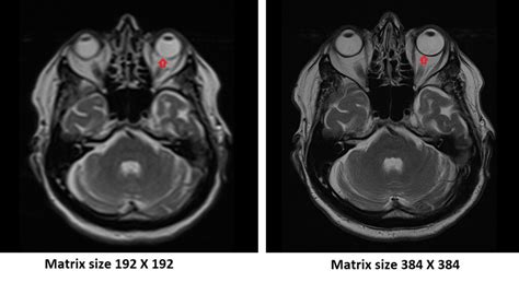 Partial Voluming Mri Partial Voluming Artifact Mri