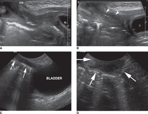 Ch 20 Pediatric Urinary Bladder And Adrenal Glands Flashcards Quizlet