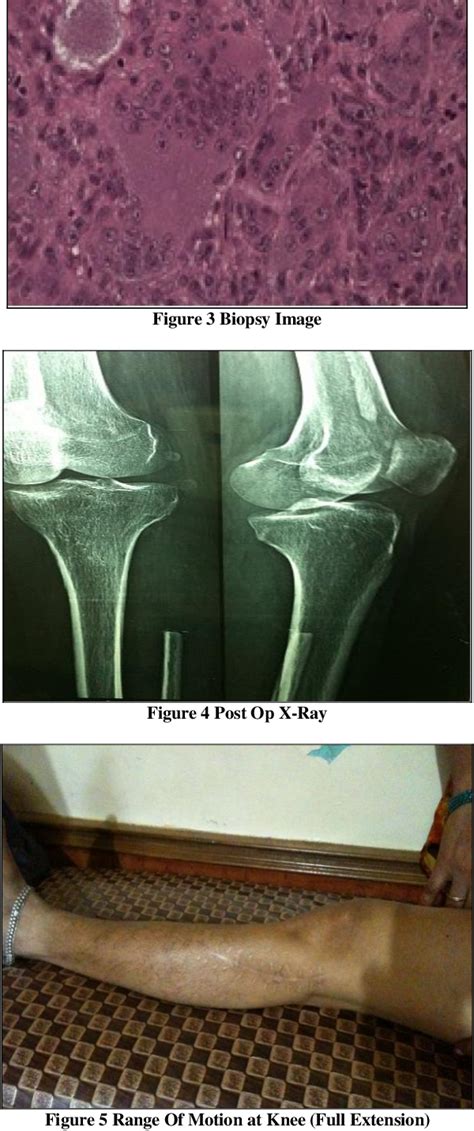 Figure 1 From Giant Cell Tumor Of Proximal Fibula Treated With En Block