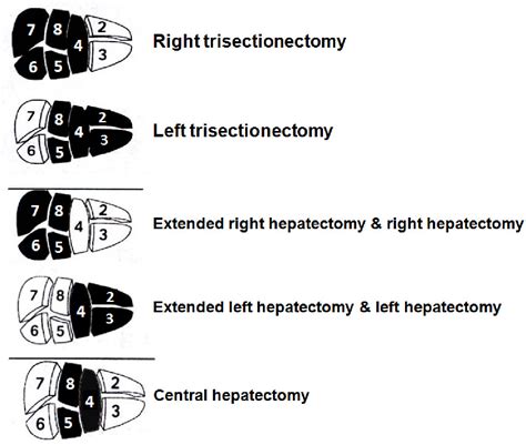 Figure 1 From Experiences Of 30 Years In Right Trisectionectomy For