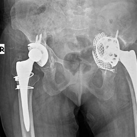 Case 1 Preoperative X Ray Of The Components Both Acetabular Mesh And Download Scientific