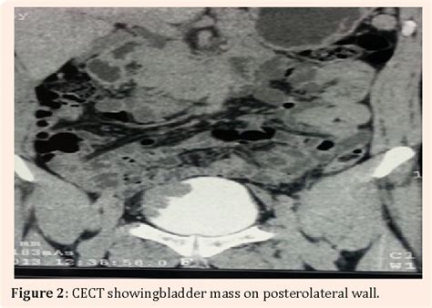 Figure 1 From Synchronous Double Primary Cancer Of The Penisand Urinary
