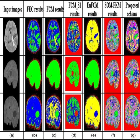 Segmentation Outcomes Of Primitive Neuro Ectodermal Tumour In Brain Mr