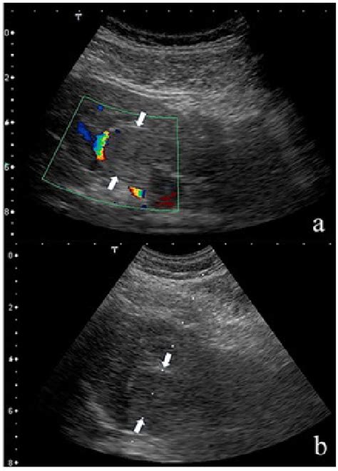 A Color Doppler Ultrasonogram Showing Thrombosis Arrows In The