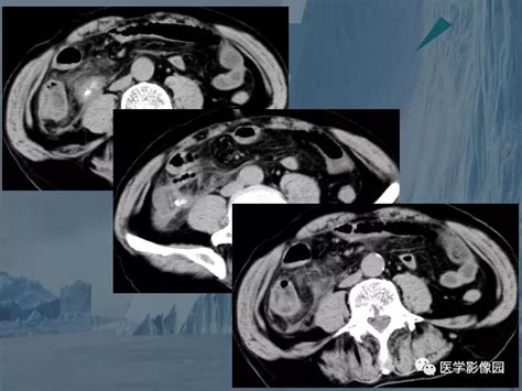 阑尾炎的CT诊断 MedSci cn
