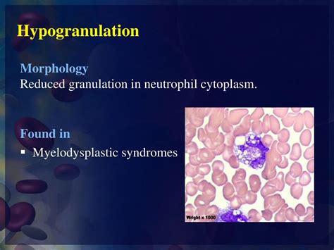 Ppt Wbcs And Plt Abnormal Morphology Powerpoint Presentation Free Download Id 6378150