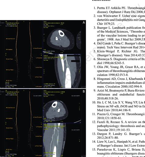 A And B Angio Tc Of Lower Limbs Stenosisocclusion Of The Tibial