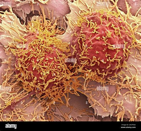 Liver Cancer Cells Coloured Scanning Electron Micrograph Sem Of Two