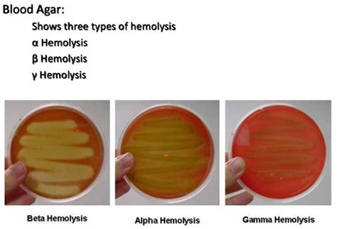 Haemolysis Of Streptococci And Its Types With Examples