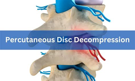 Percutaneous Disc Decompression Expert Back Pain Treatment