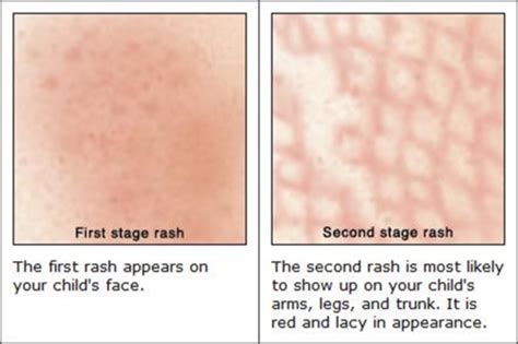 Erythema Infectiosum Lacy Rash