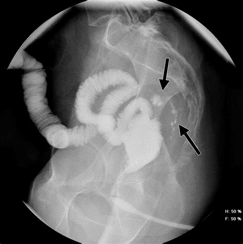 Complications After J Pouch Surgery At Jason Lindstrom Blog