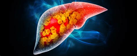 Hepatic Steatosis Improved With Efimosfermin In Mash