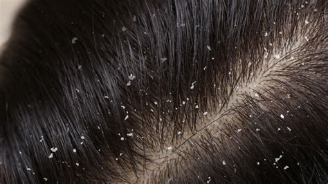Lets Talk Dandruff Why You Get It How You Can Treat It And Everything