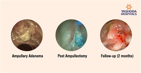 Endoscopic Ampullectomy With Ercp For Ampullary Adenomasyashoda Hospitals Endoscopic Ampullectomy With Ercp For Ampullary Adenomasyashoda Hospitals