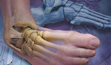 Avulsion Fracture Ankle Swelling