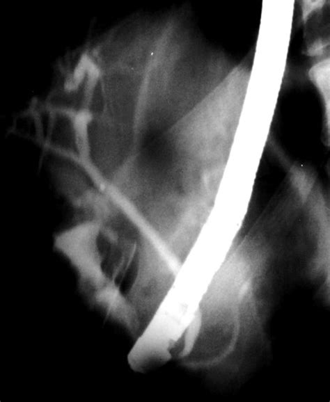 Cholangiography Of A Case Without Dilation In CBD CBD And PD In Normal Download Scientific