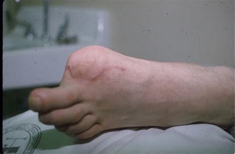 Unit 6 Amputations Flashcards Quizlet