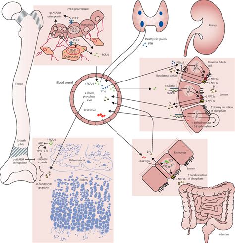 X Linked Hypophosphataemia The Lancet X Linked Hypophosphataemia The Lancet