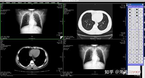 【c医学影像pacs】ct检查中的三维重建是什么检查？ 知乎