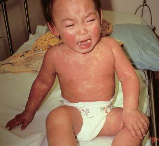 Rash Drug Eruptions Anesthesia Key