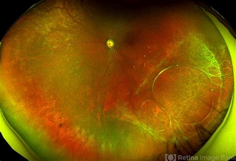 Retinoschisis Retina Image Bank