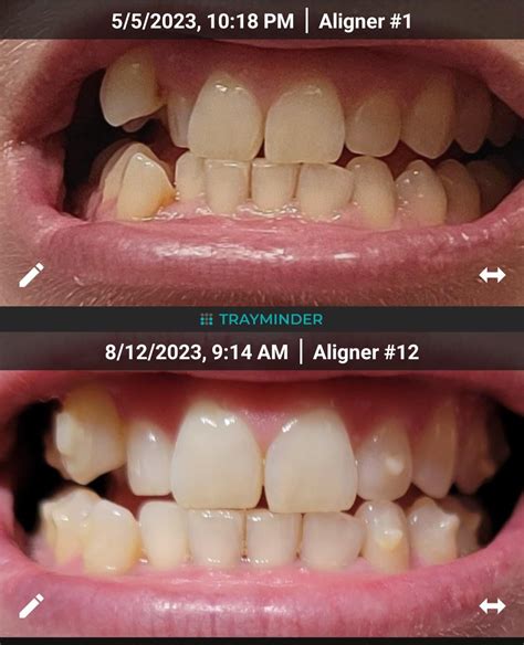 Progress Pics Rinvisalign