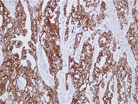 Immuno Histochemistry Showing Focal Positivity For CK 20 Cytokeratin