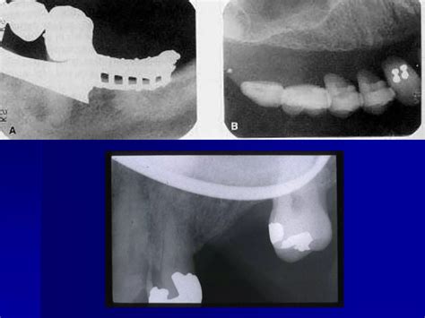Radiographic Errors And Artifacts Pptx