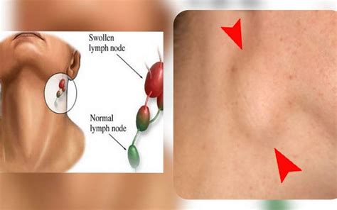 Kesan Awal Kanser Limfoma Sahih