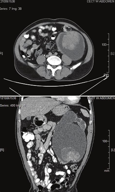 Computed Tomography Scan Demonstrating Renal Collecting System Tumor Download Scientific