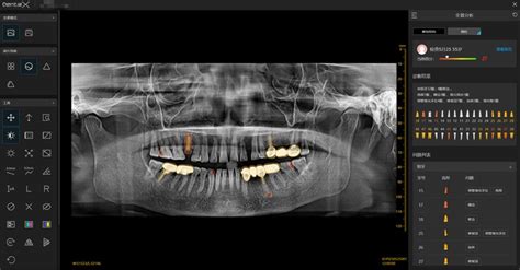 牙医管家丨ai如何辅助牙医做口腔影像诊断 菲森fussen新闻