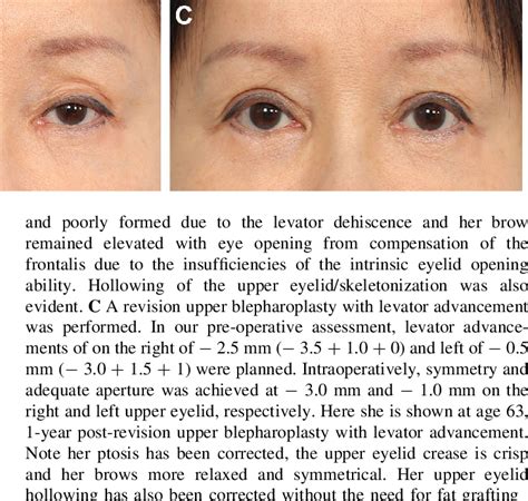 A This Case Illustrates The Development Of Post Upper Blepharoplasty