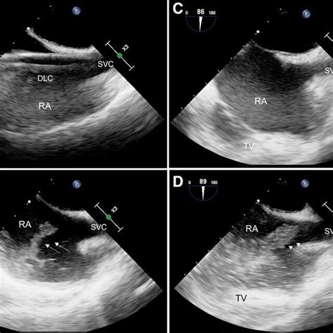 A Bicaval View And C Modified Bicaval View Without Contrast B