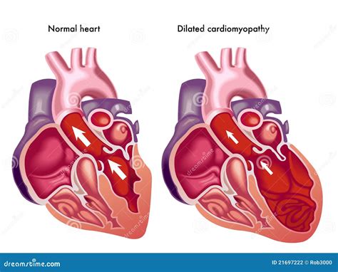 Dilated Cardiomyopathy Stock Vector Illustration Of Cardiology 21697222