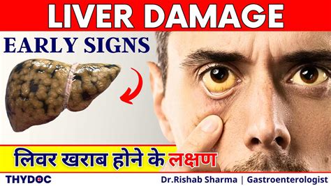 Liver Kharab Hone Ke Lakshan Liver Cirrhosis Early Signs Liver