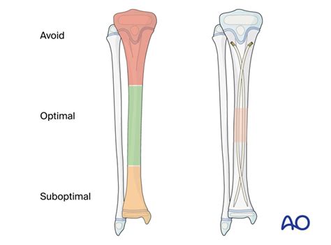 Elastic Nailing For Simple Transverse Tibial Fracture Elastic Nailing For Simple Transverse Tibial Fracture
