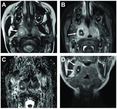 A Peritonsillar Abscess Pta Asterisk In A 10 Year Old On Axial