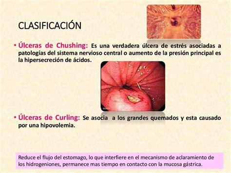 Ulceras Por Estrés Cushing Y Curling