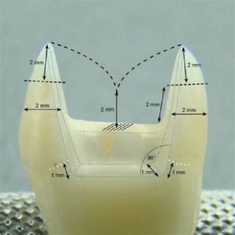 Palatal Cusp Of Tooth Semantic Scholar