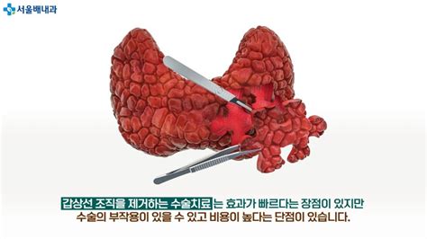 갑상선기능항진증 치료 약물 메티마졸요오드 수술치료 네이버 블로그